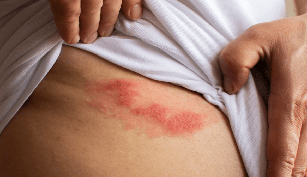 Pásový opar – ako vyzerá, príznaky, liečba - KD.sk