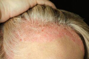 Psoriáza - čo je to, ako vyzerá, liečba - KD.sk