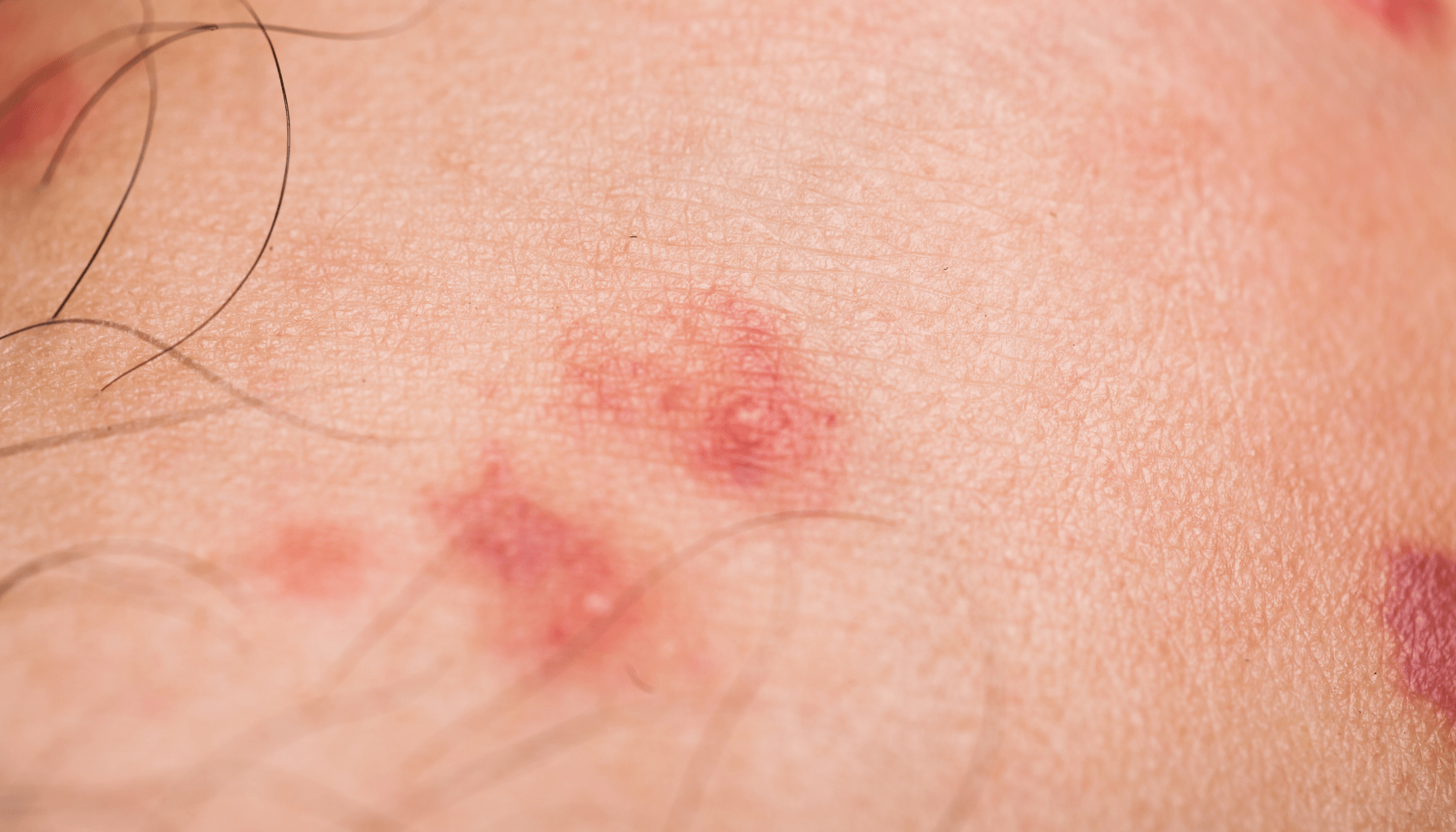 Štípance od blchy - ako vyzerajú, ako sa ich zbaviť, čo neznášajú - KD.sk